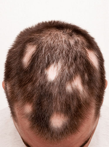 Alopecia Hair Conditions UK Hair Consultants